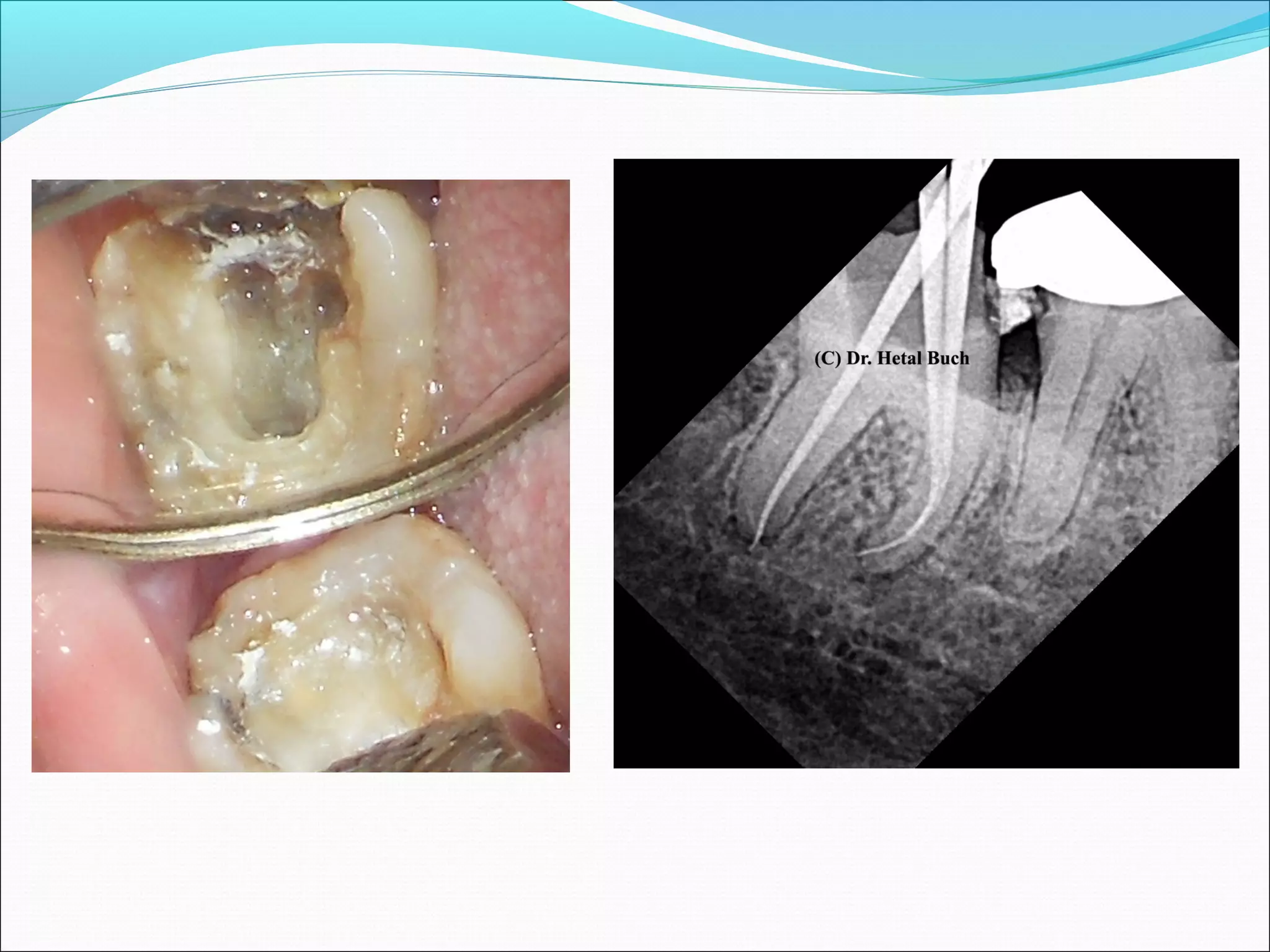 Root canal treatment in third molar | PPT