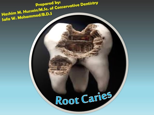 Root Caries | PDF | Dental Health | Diseases and Conditions