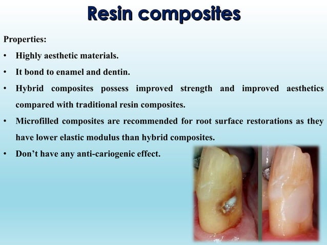 Root Caries | PDF | Dental Health | Diseases and Conditions