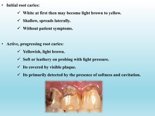 Root Caries | PDF