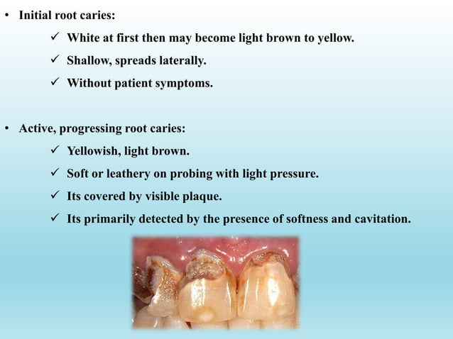 Root Caries | PDF | Dental Health | Diseases and Conditions