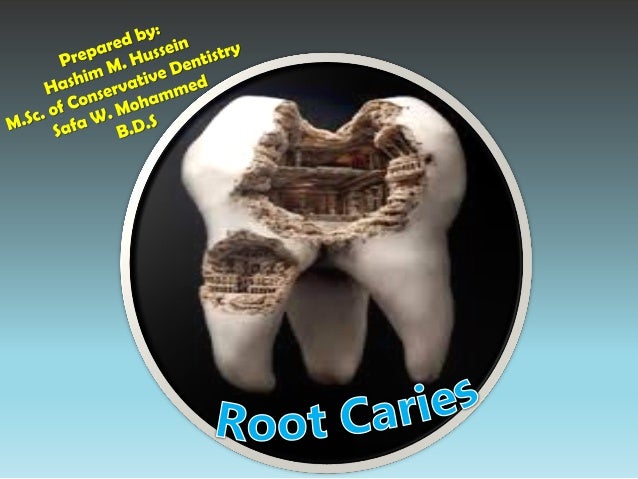 Root Caries