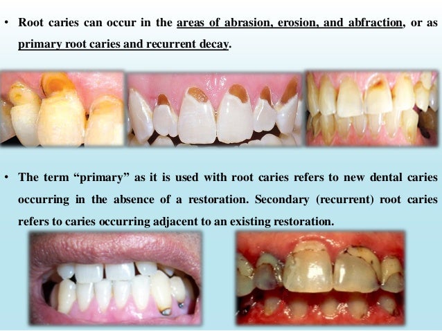 Root Caries