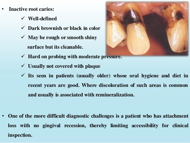 Root Caries