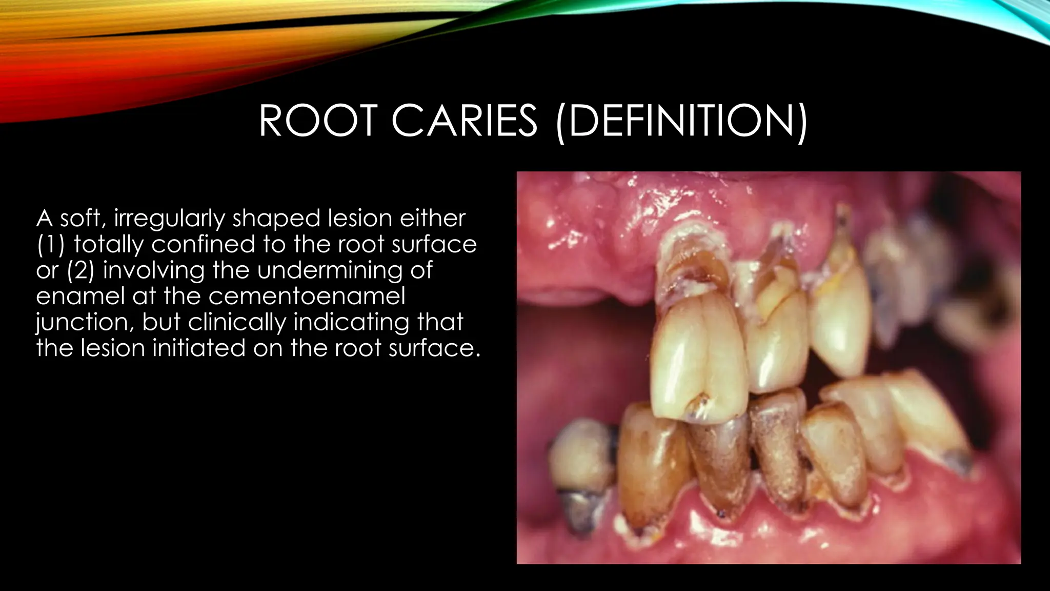 Root caries and class Vclass five tooth.pptx