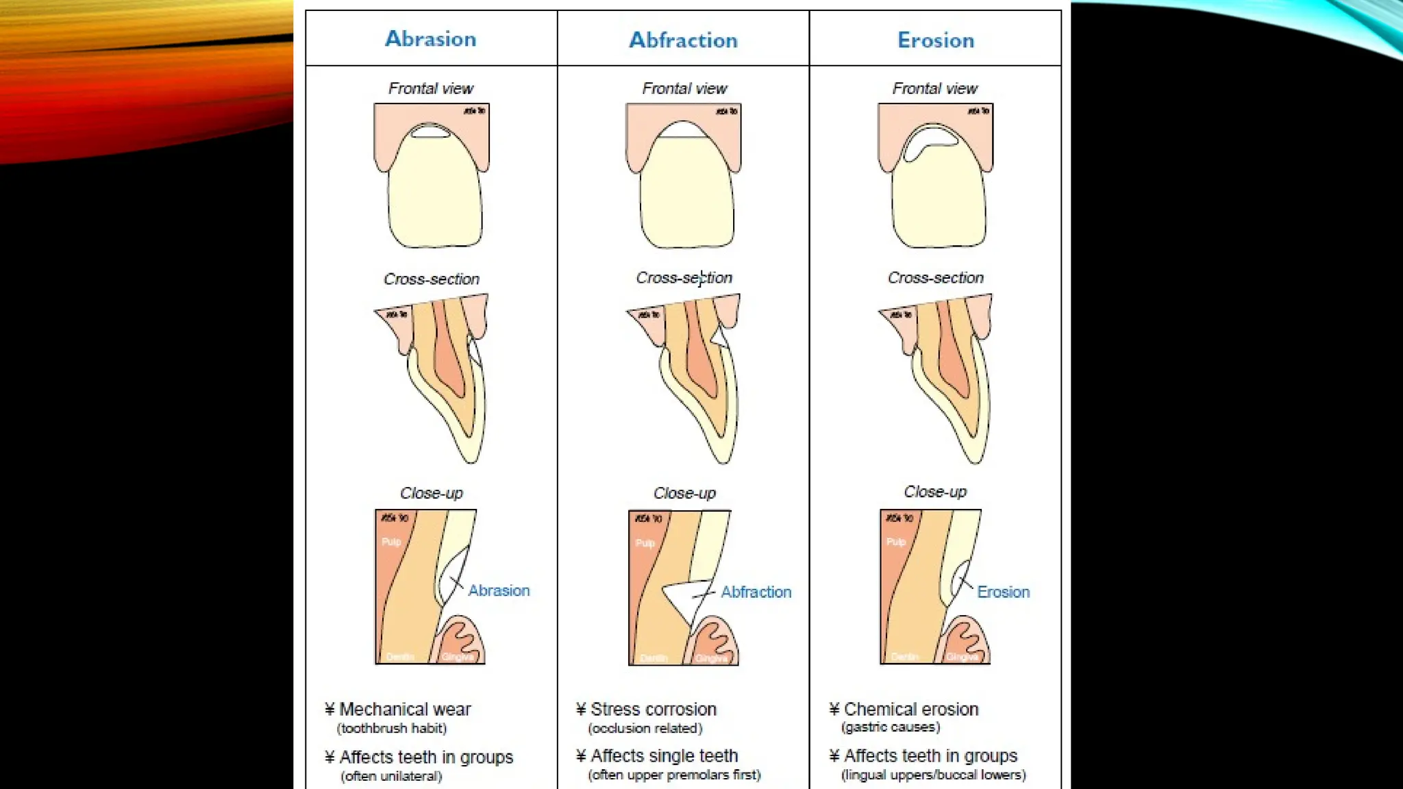 Root caries and class Vclass five tooth.pptx