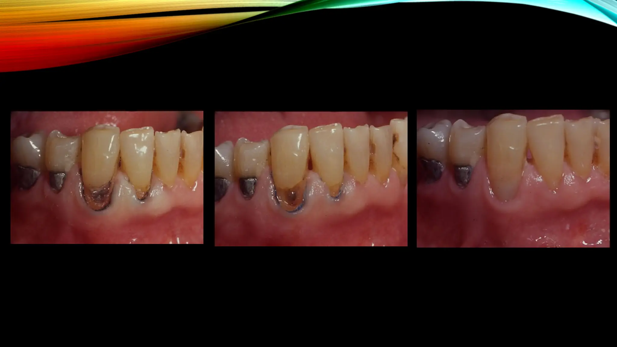 Root caries and class Vclass five tooth.pptx