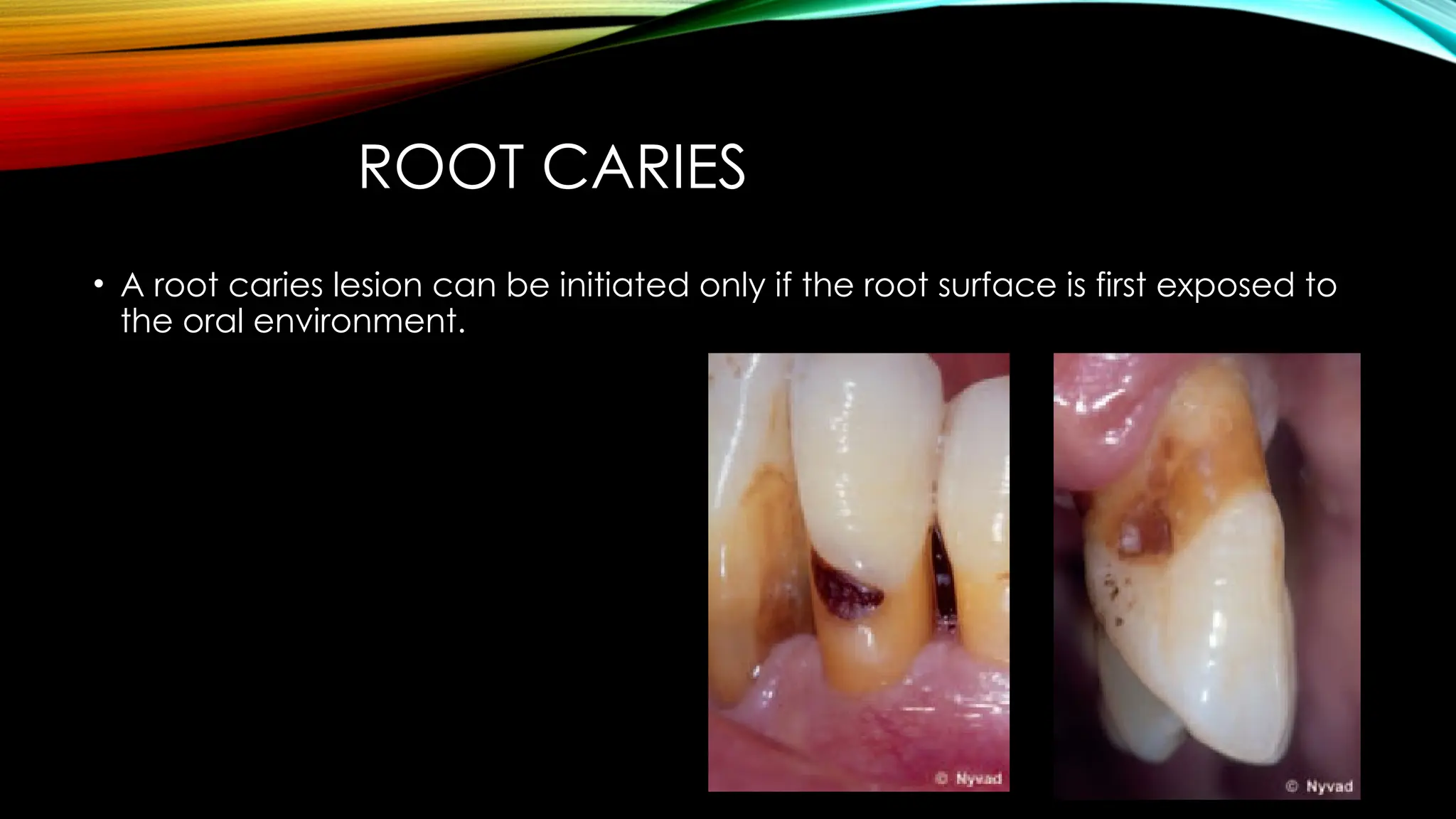 Root caries and class Vclass five tooth.pptx