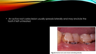Root caries and class Vclass five tooth.pptx