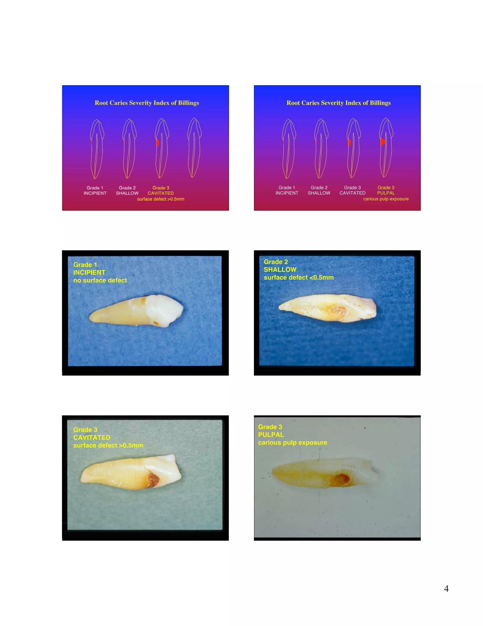 Root caries restoration.07.ppt