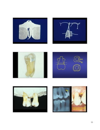 Root caries restoration.07.ppt
