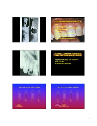 Root caries restoration.07.ppt
