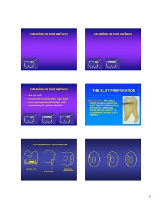 Root caries restoration.07.ppt