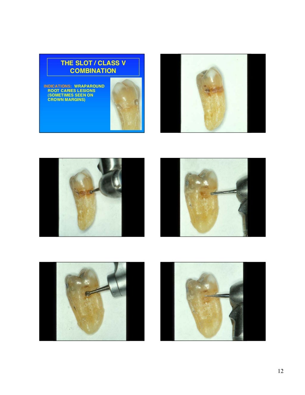 Root Caries Restoration07ppt