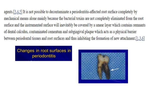 Root conditioning | PPTX