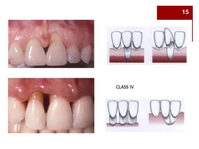 Root coverage procedures. Dr. Kinjal ghelani | PPTX