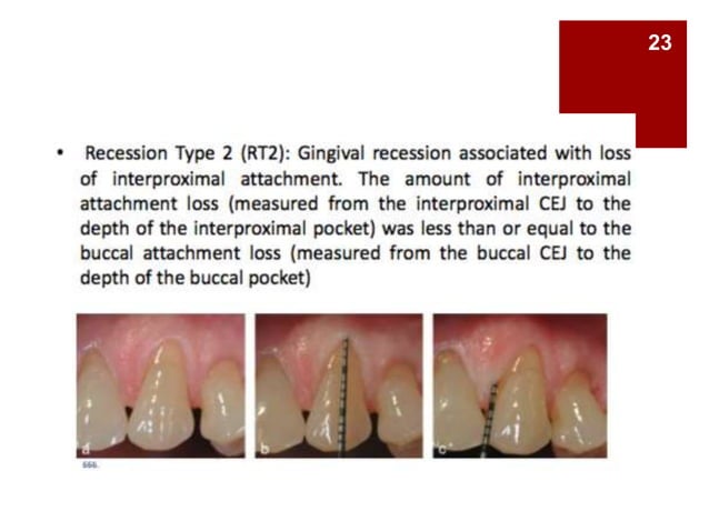 Root coverage procedures. Dr. Kinjal ghelani | PPTX