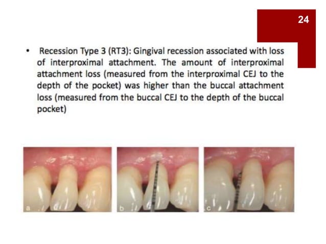 Root coverage procedures. Dr. Kinjal ghelani | PPTX