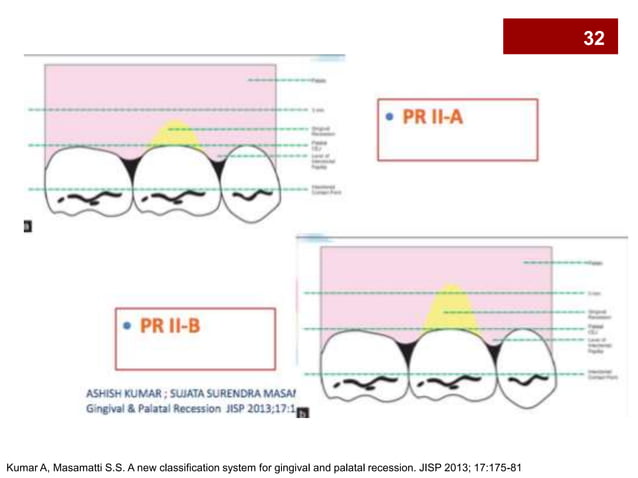 Root coverage procedures. Dr. Kinjal ghelani | PPTX