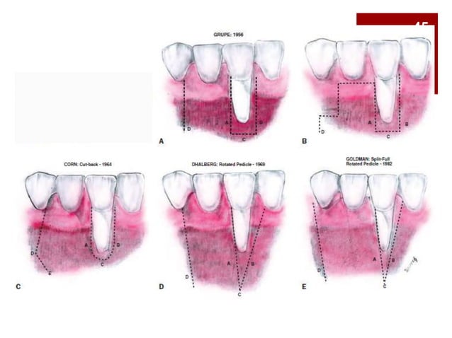 Root coverage procedures. Dr. Kinjal ghelani | PPTX