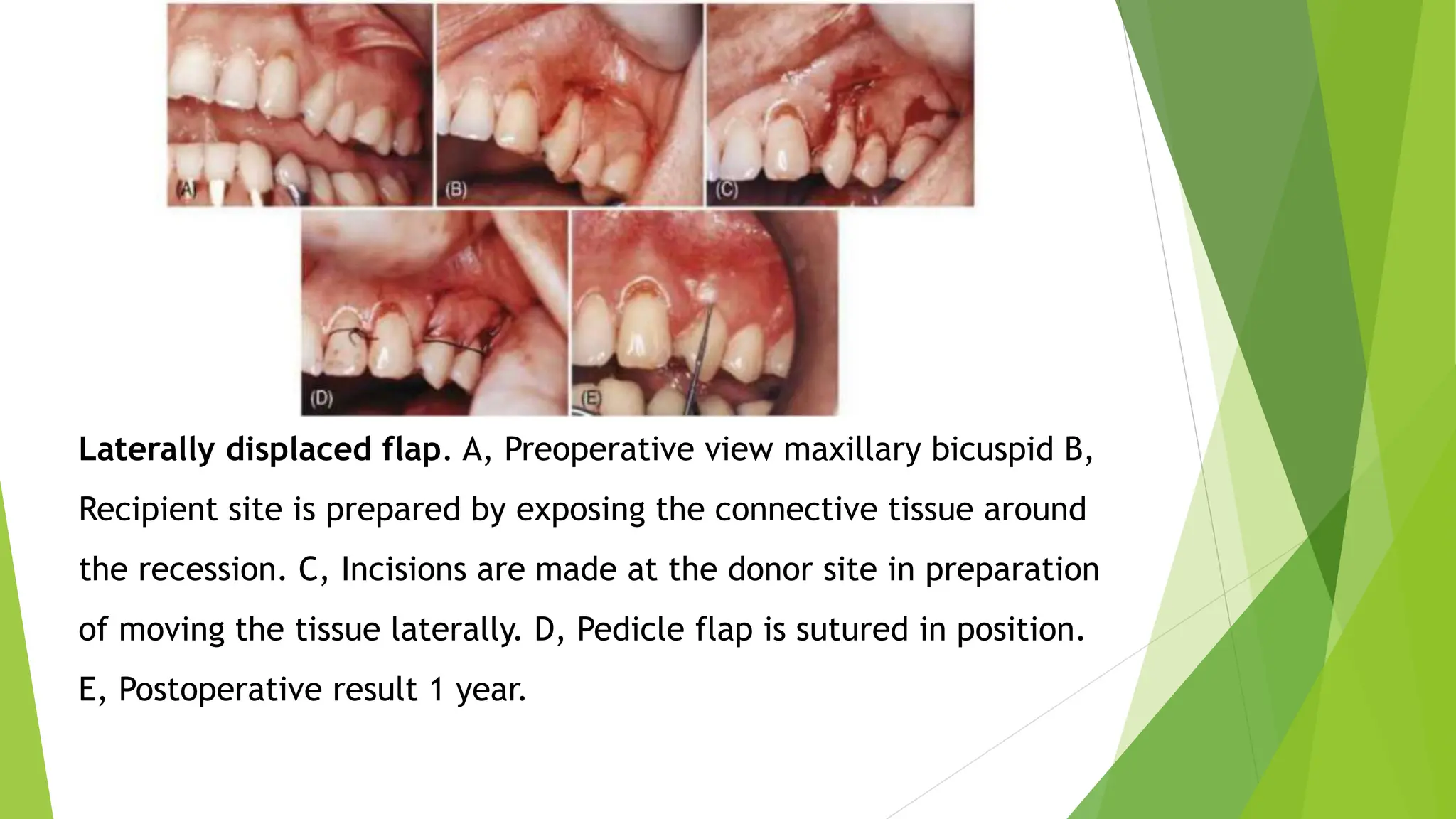 Root coverage procedures periodontics.pptx