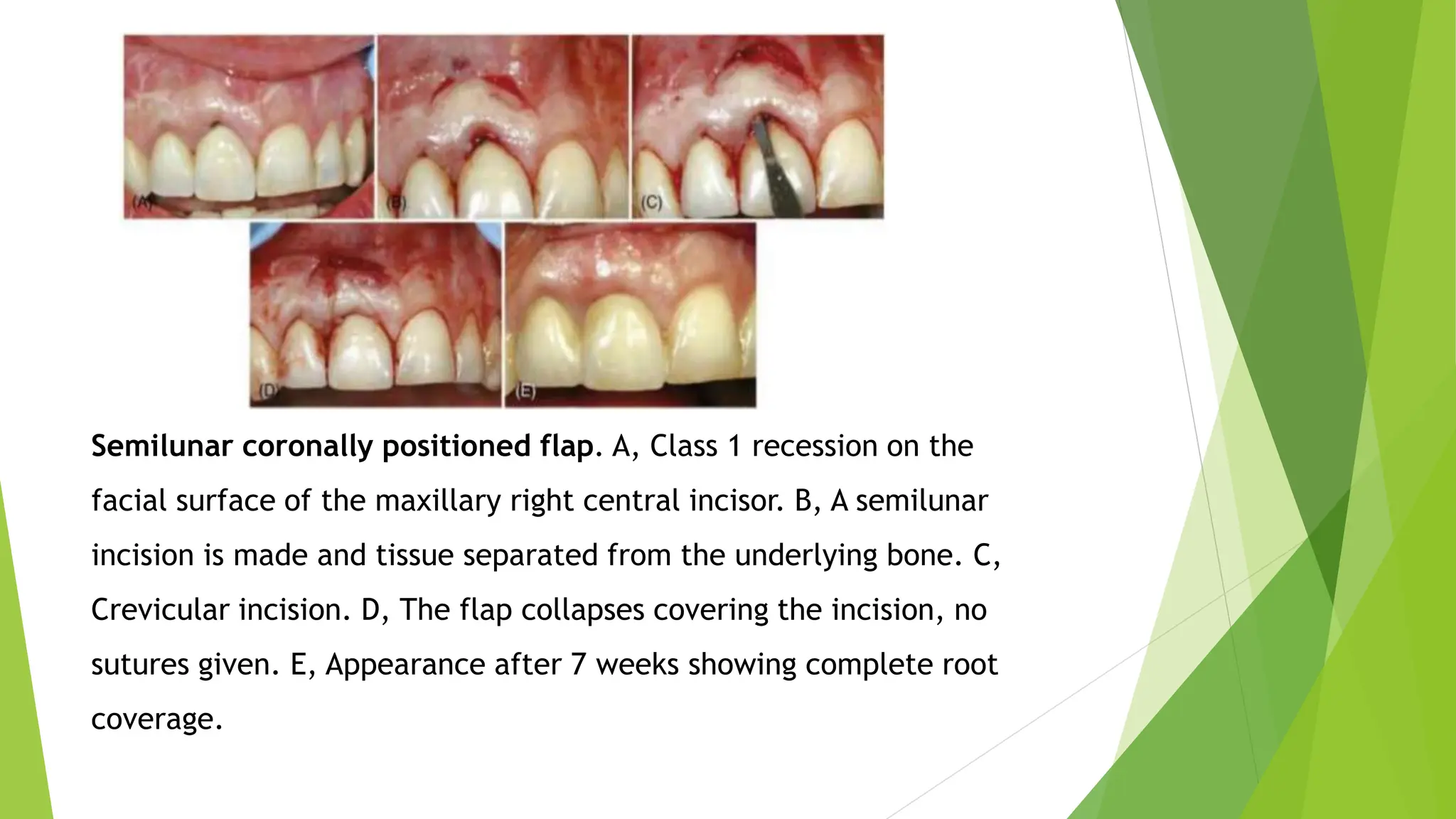 Root coverage procedures periodontics.pptx
