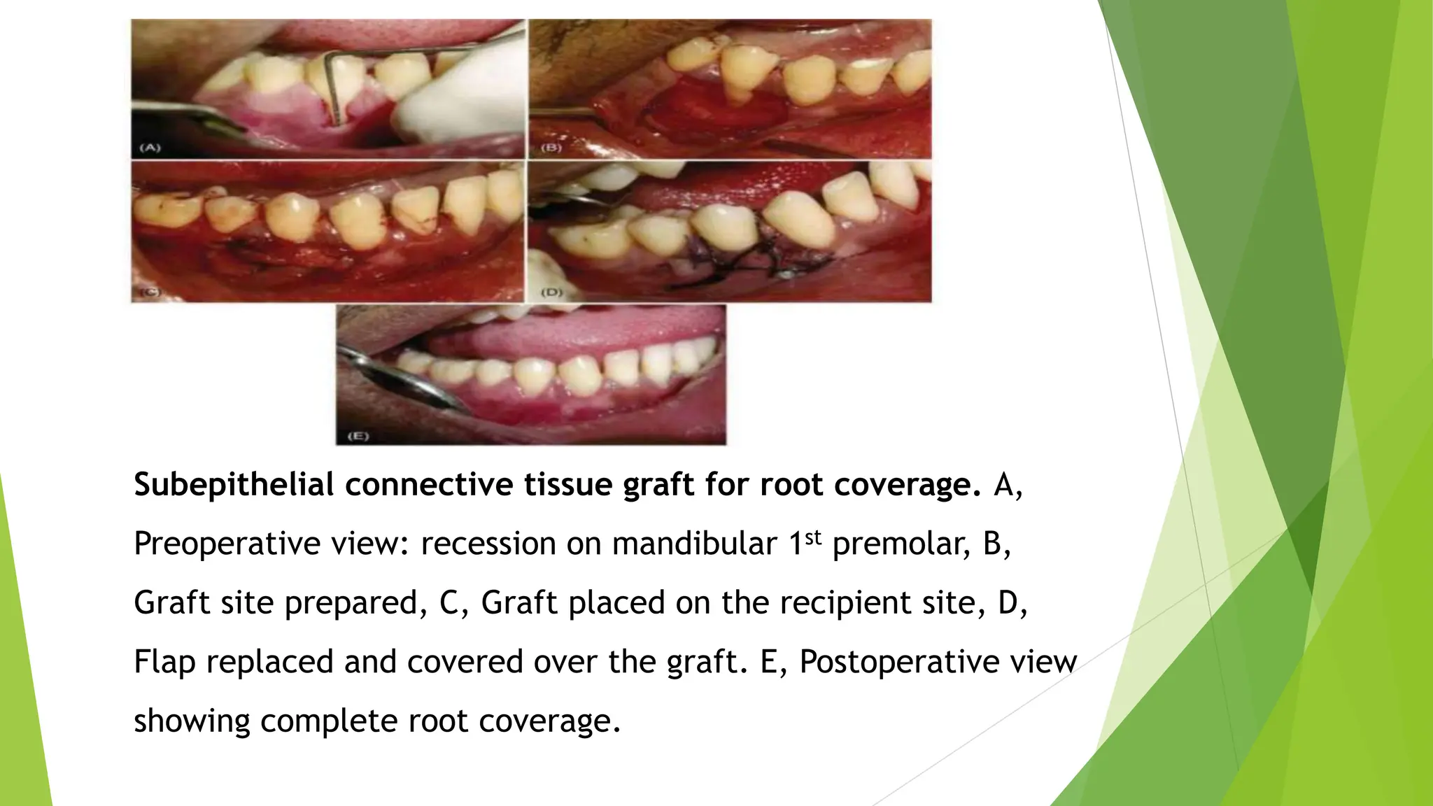 Root coverage procedures periodontics.pptx