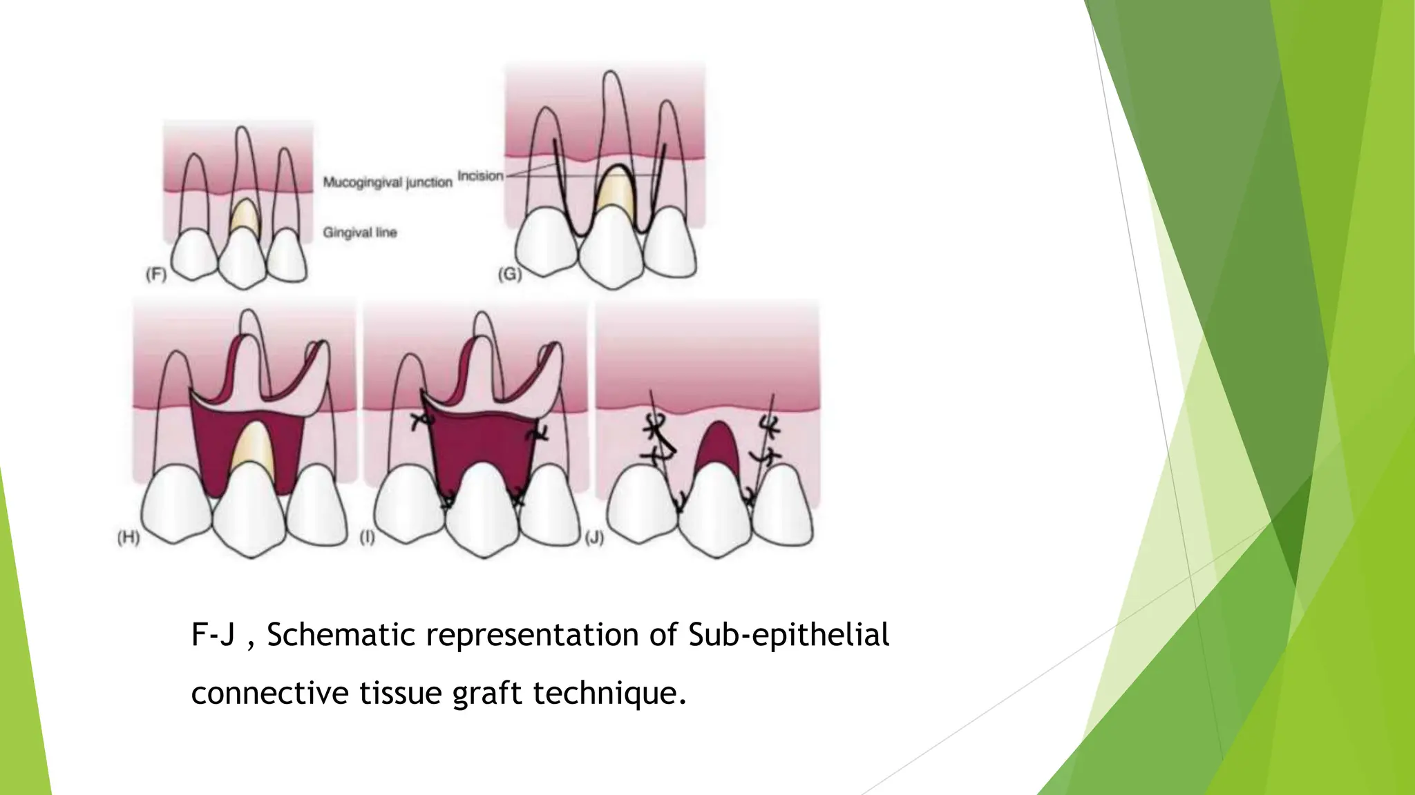 Root coverage procedures periodontics.pptx