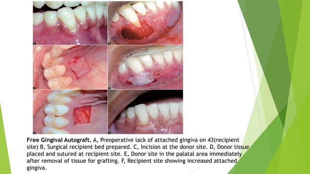 Root coverage procedures periodontics.pptx | Dental Health | Diseases ...