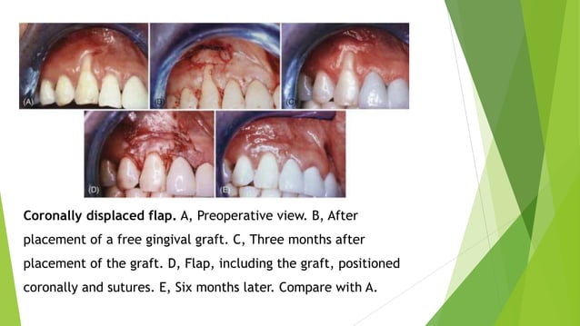 Root coverage procedures periodontics.pptx | Dental Health | Diseases ...