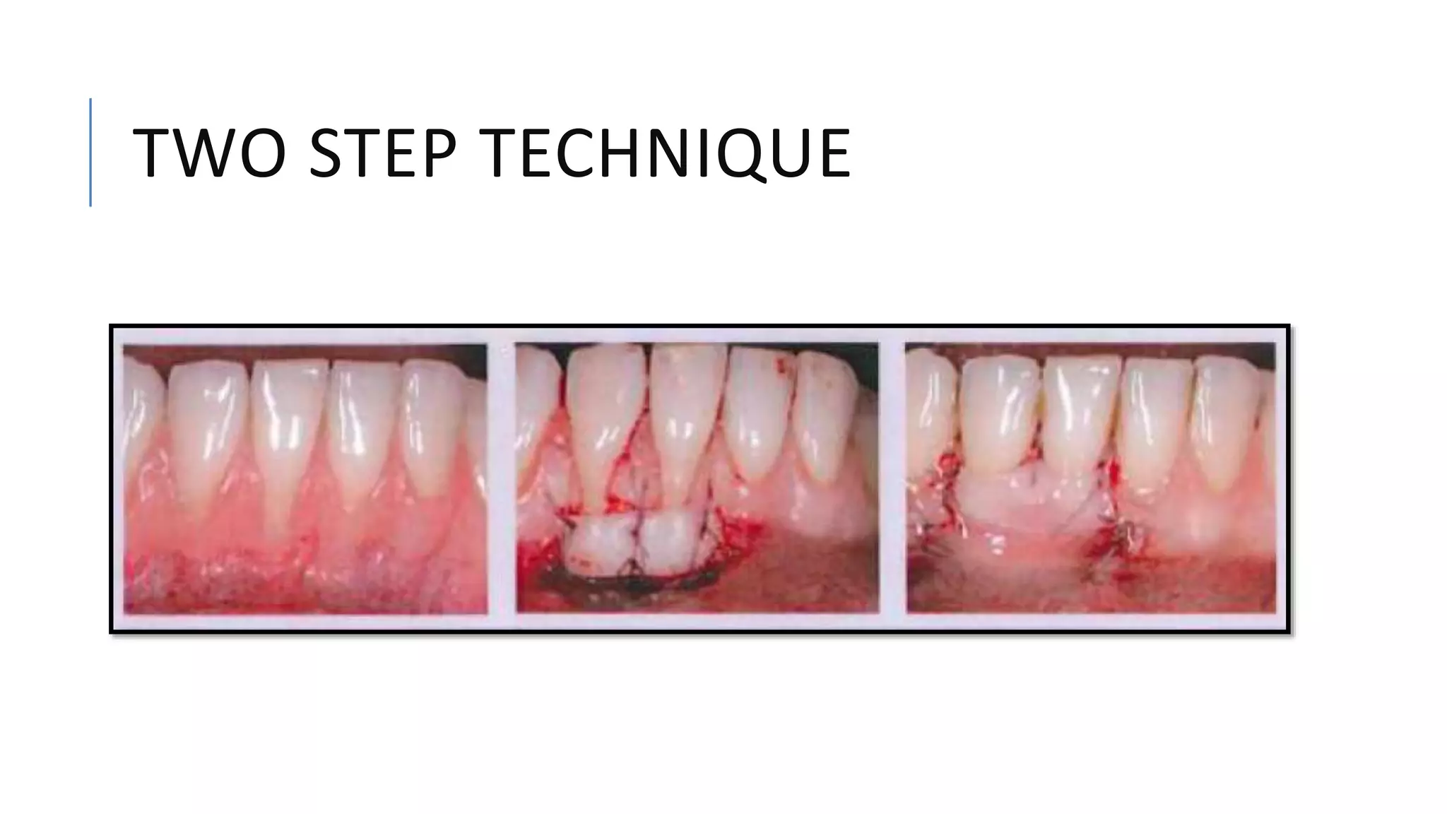 Root Coverage Surgical Techniques | PPTX