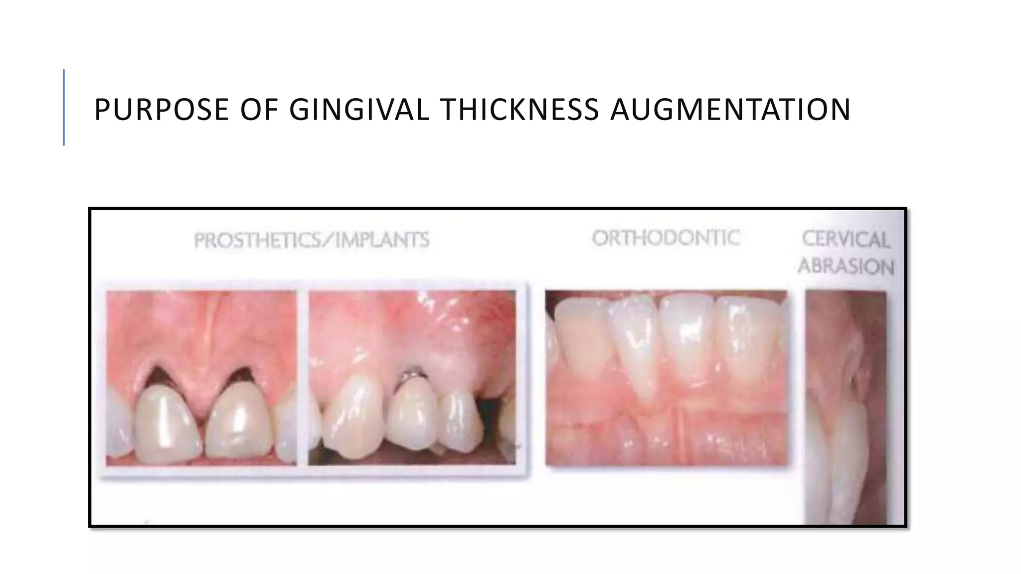 Root Coverage Surgical Techniques | PPTX