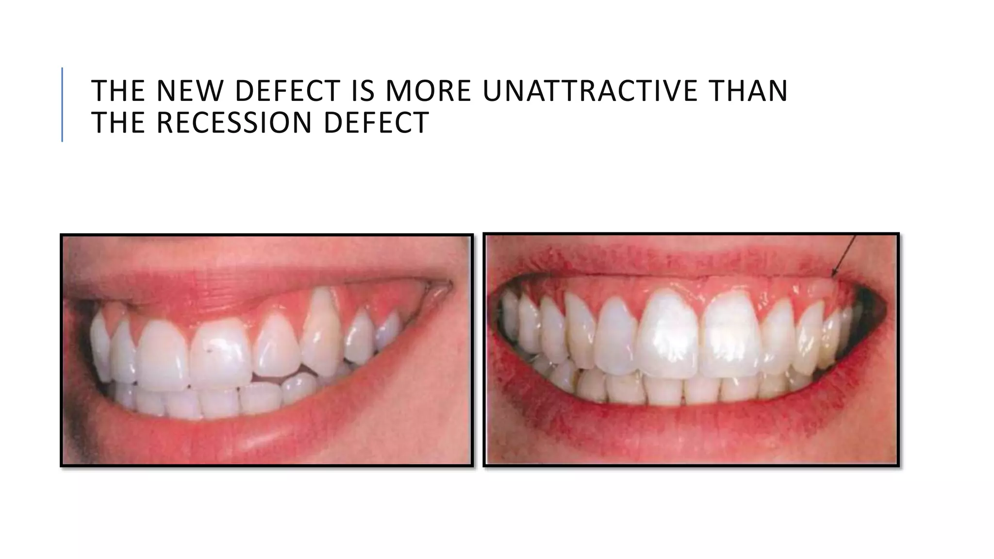 Root Coverage Surgical Techniques | PPTX