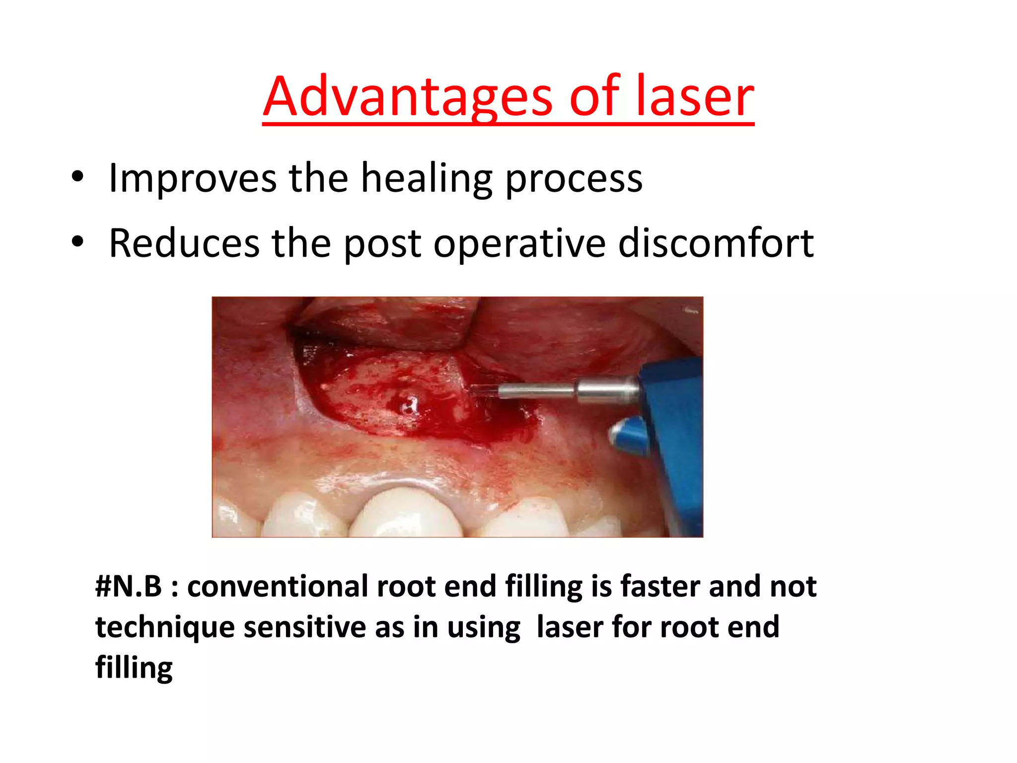 Root end filling | PPTX
