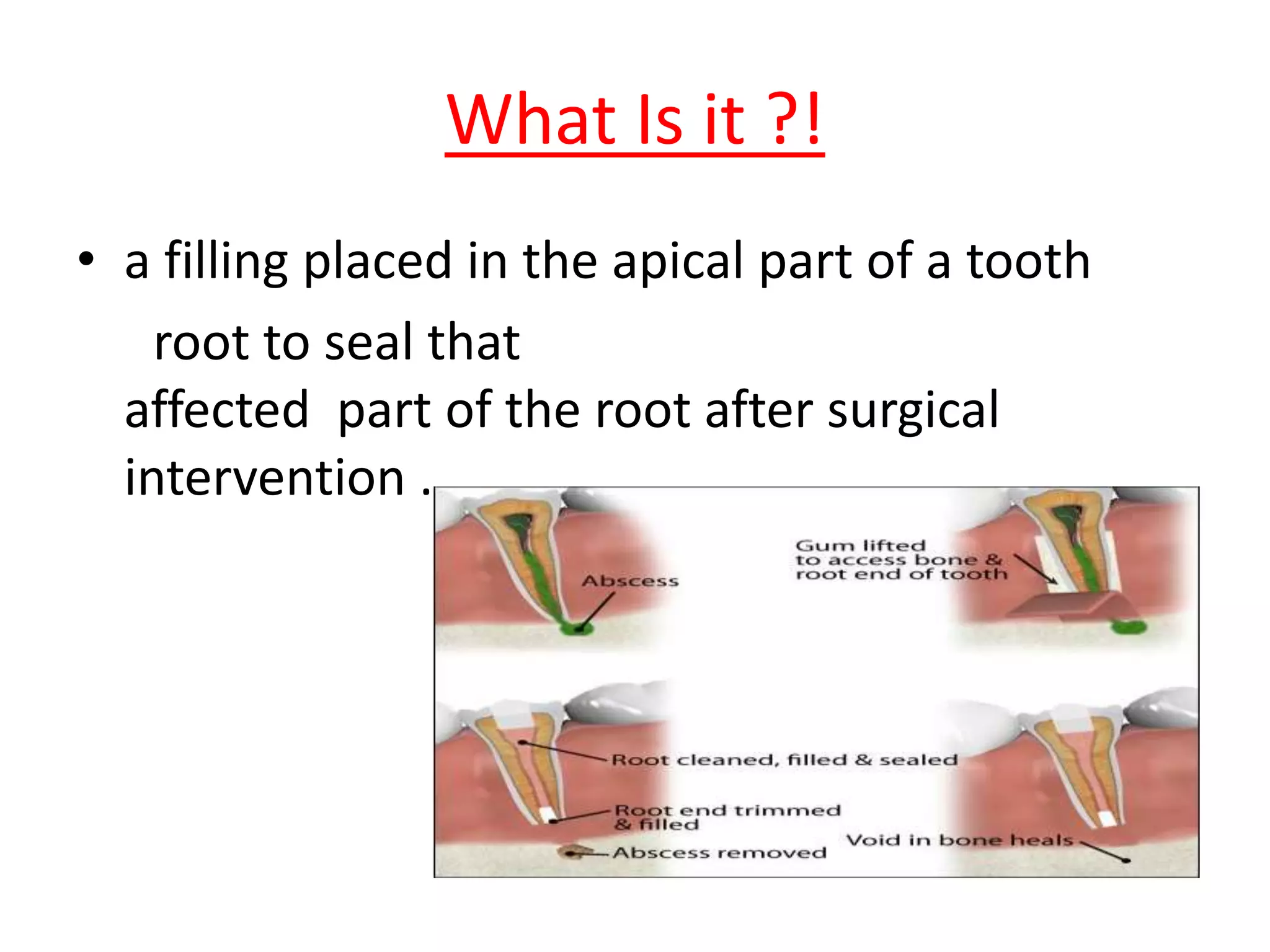 Root end filling | PPTX