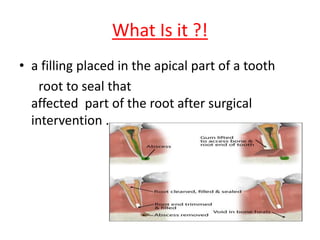 Root end filling | PPTX