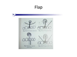 Root end filling | PPTX