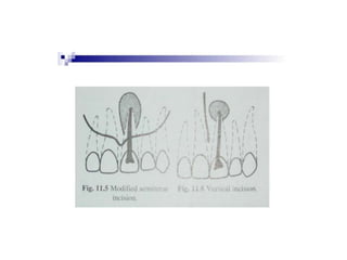 Root end filling | PPTX