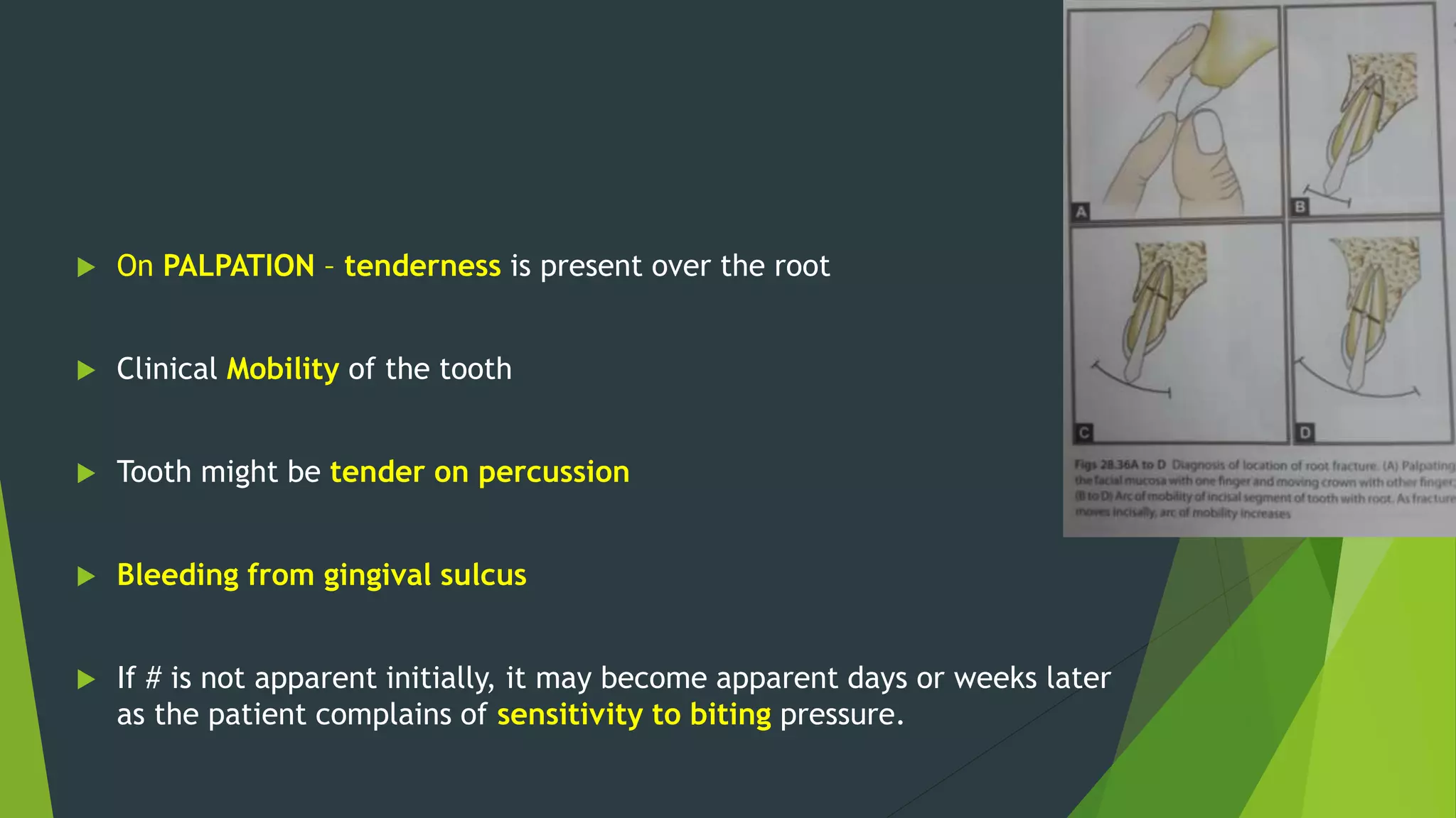 Root fractures and its management | PPTX