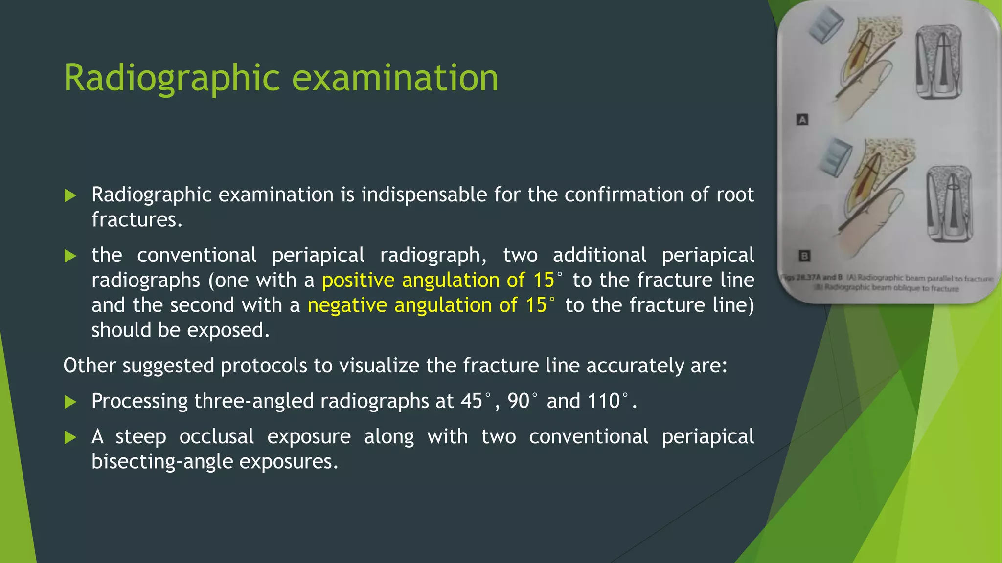 Root fractures and its management | PPTX