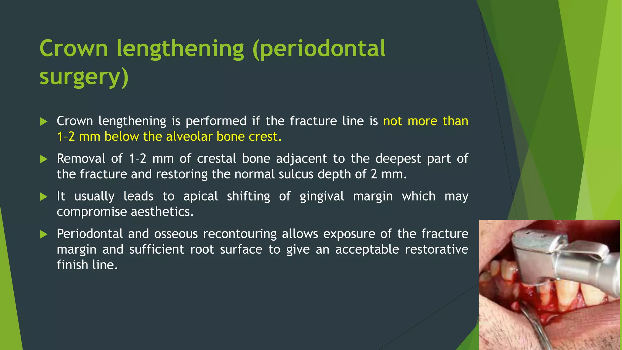 Root fractures and its management | PPTX