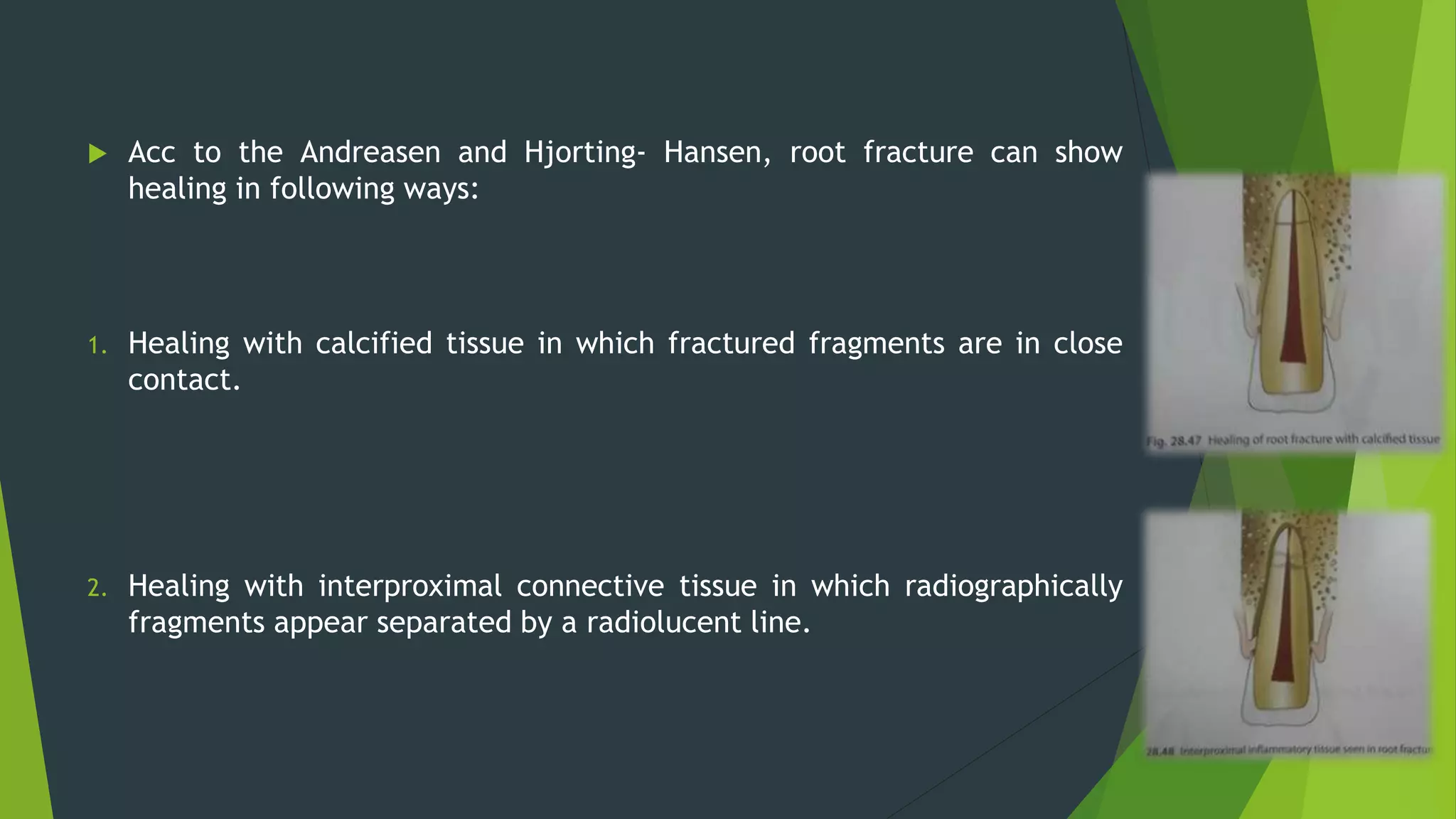 Root fractures and its management | PPTX