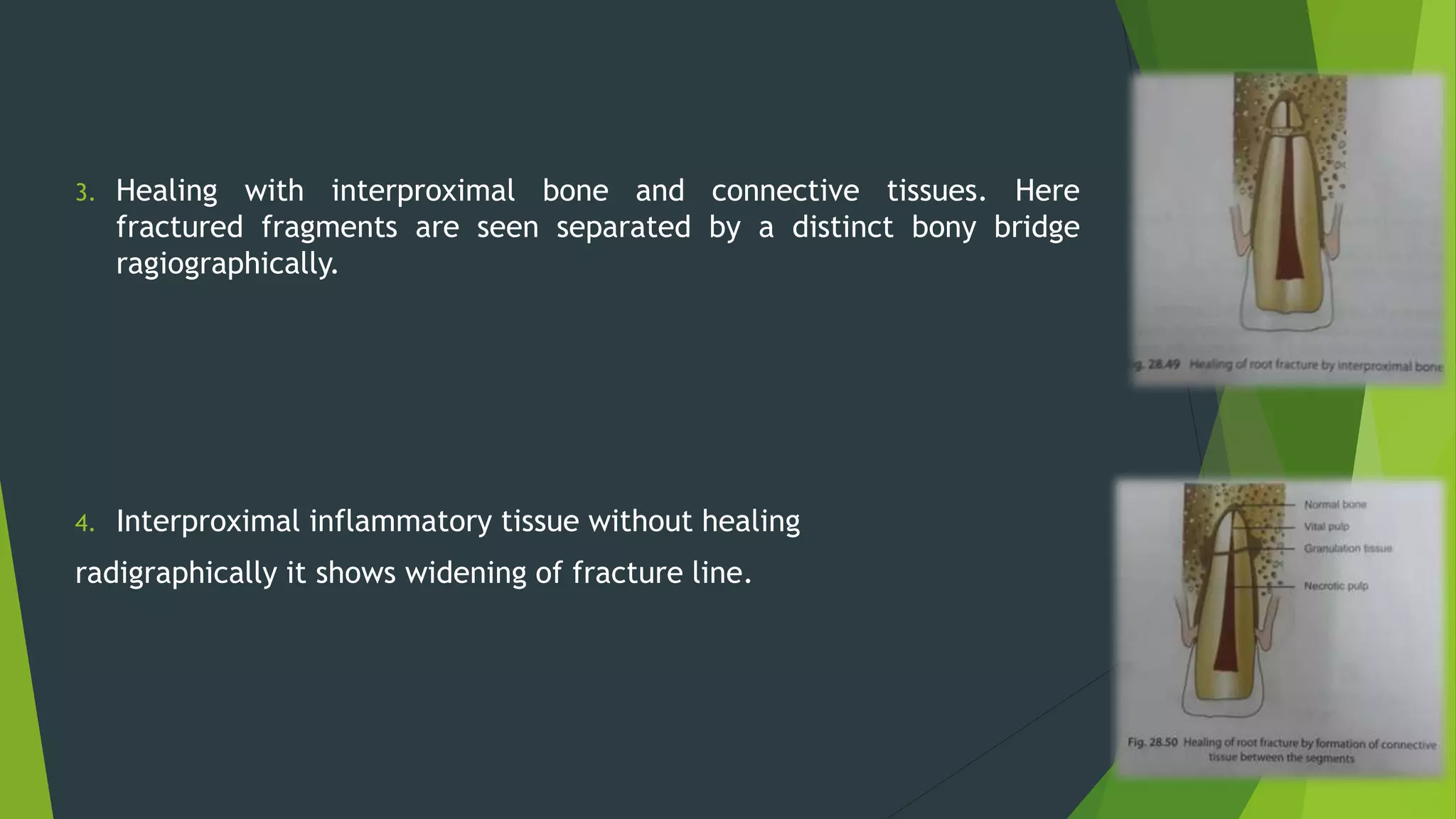 Root fractures and its management | PPTX