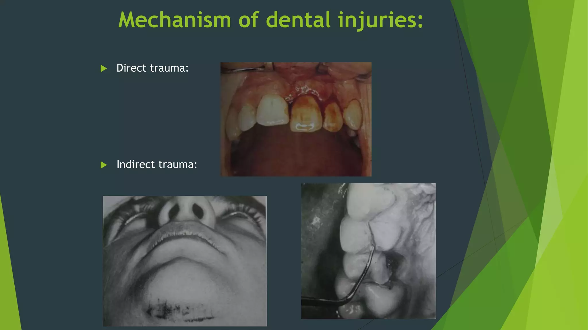 Root fractures and its management | PPTX