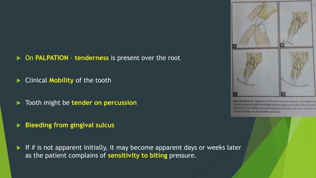 Root fractures and its management | PPTX