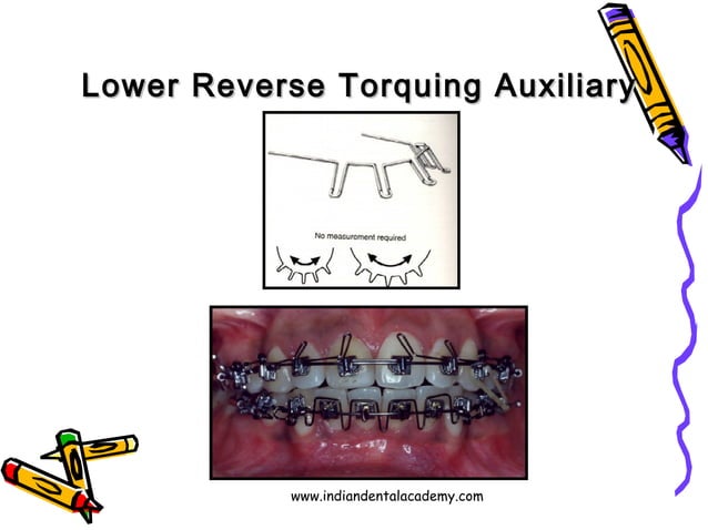 Root movement in orthodontics | PPT