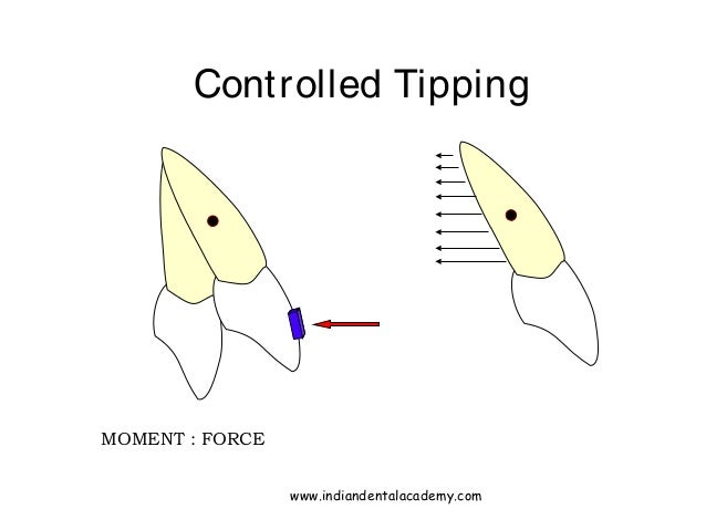 Root movement in orthodontics