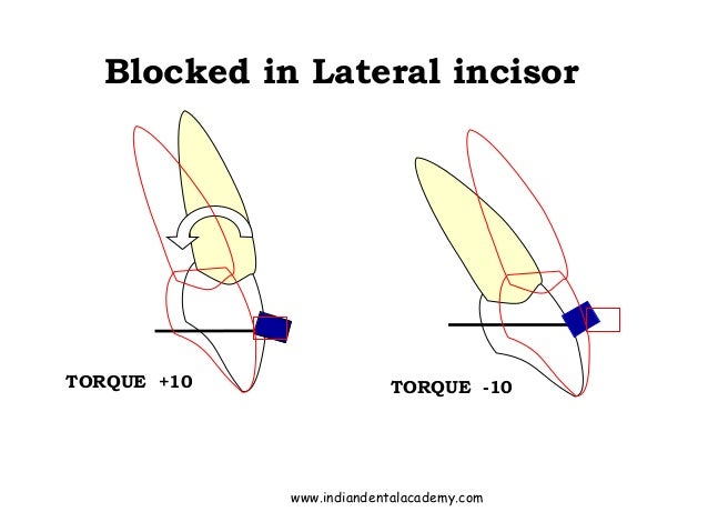 Root movement in orthodontics