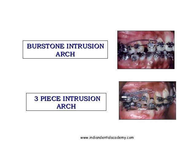Root movement in orthodontics