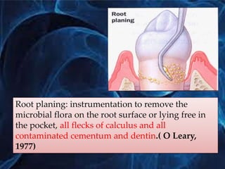 Root planing | PPT